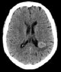 The Mind Project's Virtual Stroke Lab EMR Entry - Reading CT Scans